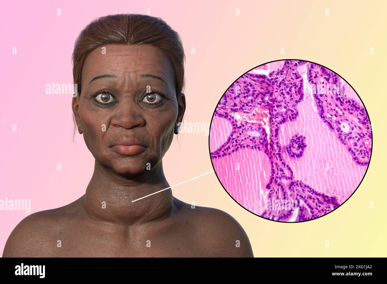 Illustration of a woman with Graves' disease and a close-up of the ...