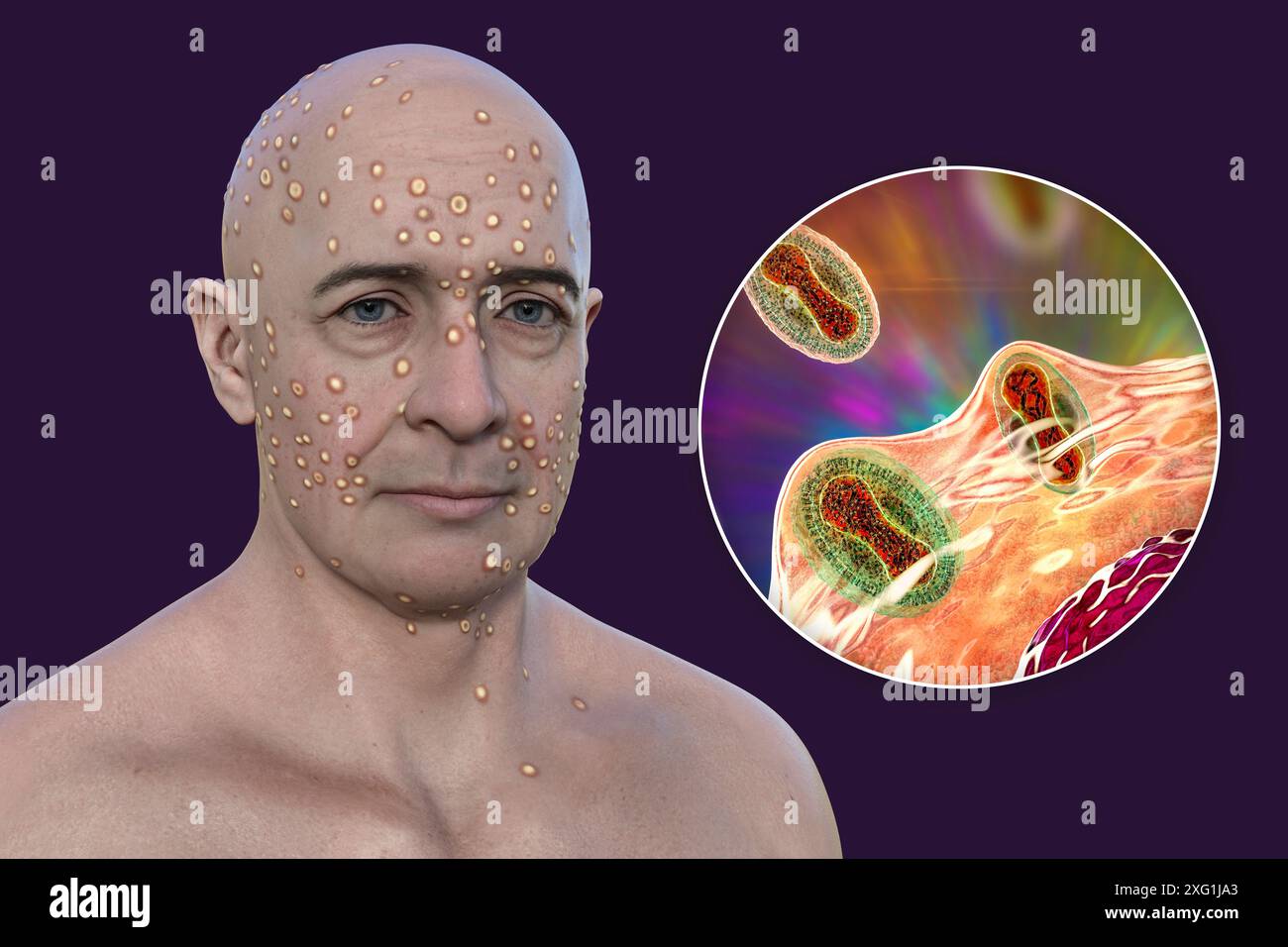 Monkeypox rash hi-res stock photography and images - Alamy