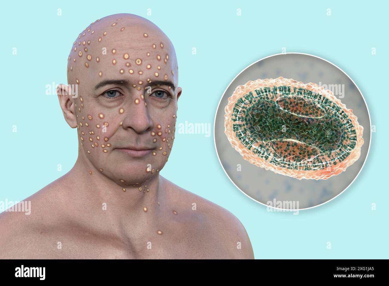 Smallpox skin lesions hi-res stock photography and images - Alamy