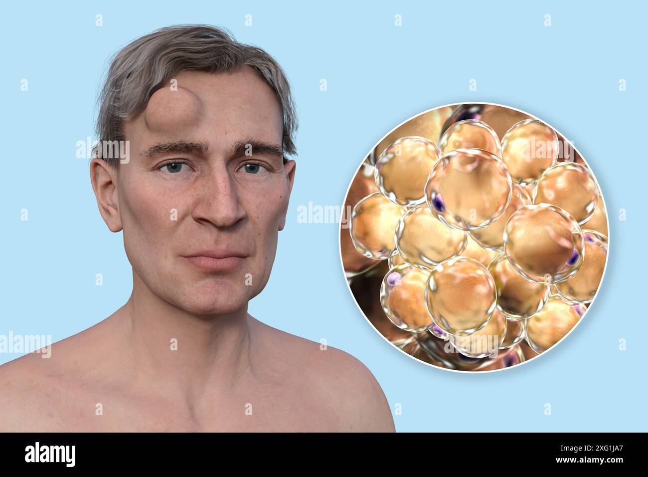 Illustration of a man with a lipoma on his forehead, and close-up view ...