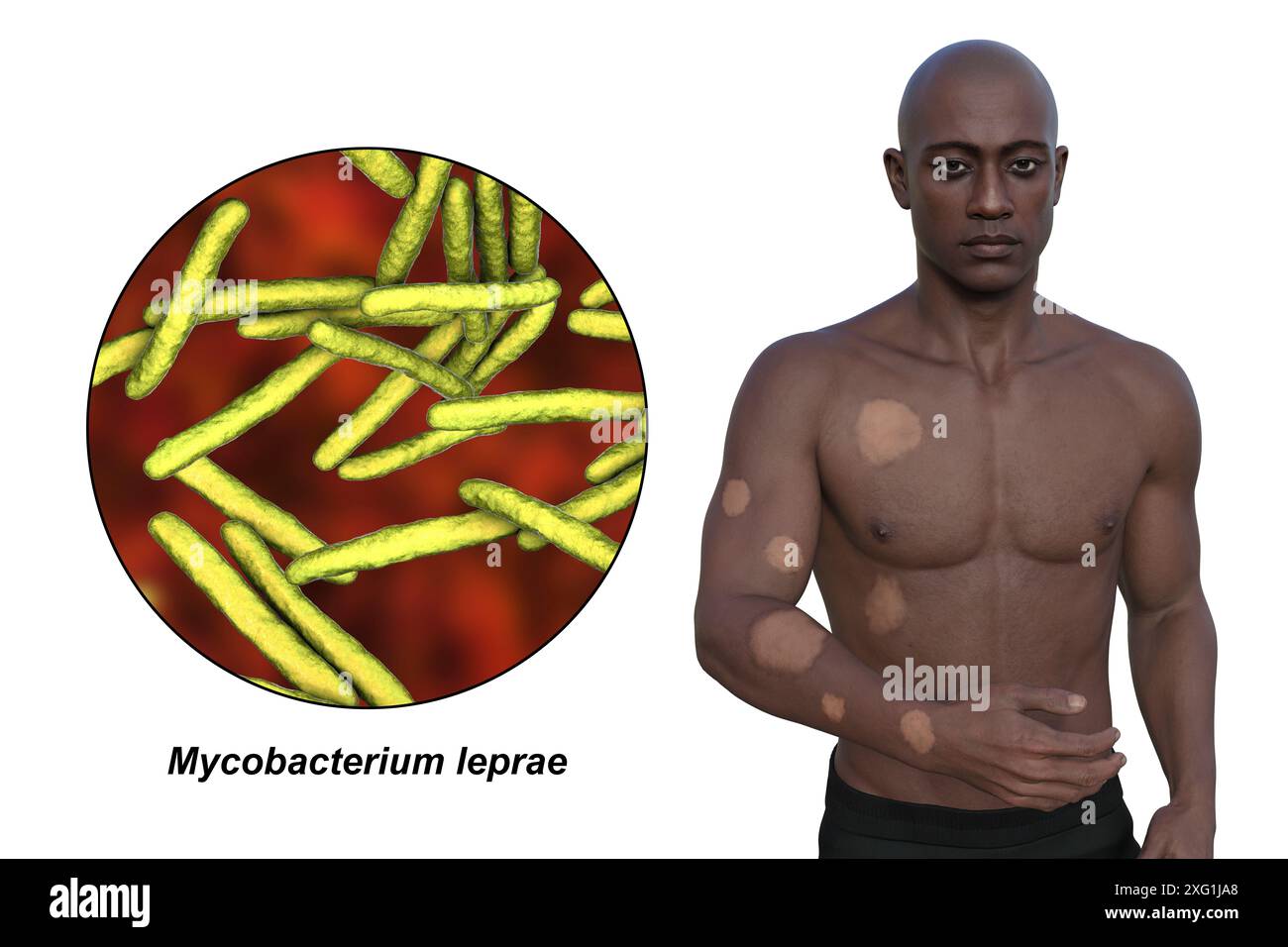 Leprosy hi-res stock photography and images - Alamy