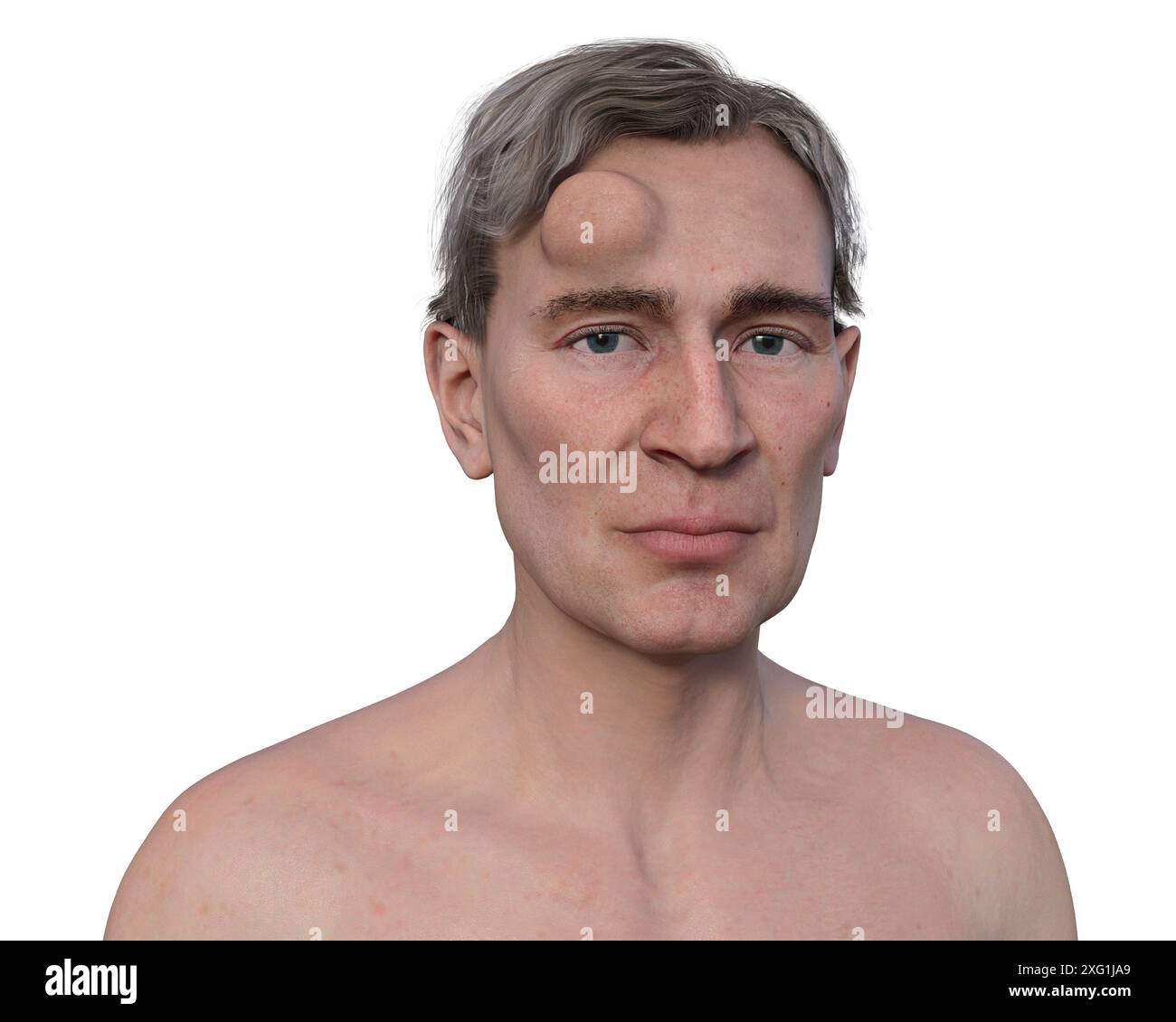 Illustration of a man with a lipoma on his forehead. Lipomas are benign ...