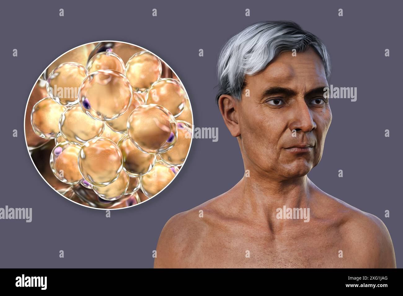 Illustration of a man with a lipoma on his forehead, and close-up view ...