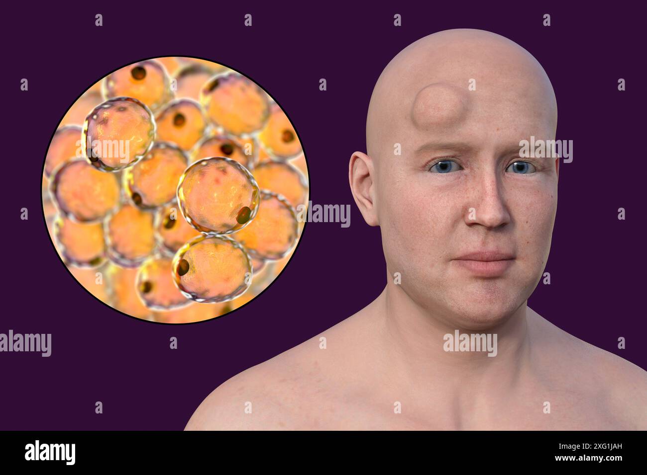 Illustration of a man with a lipoma on his forehead, and close-up view ...