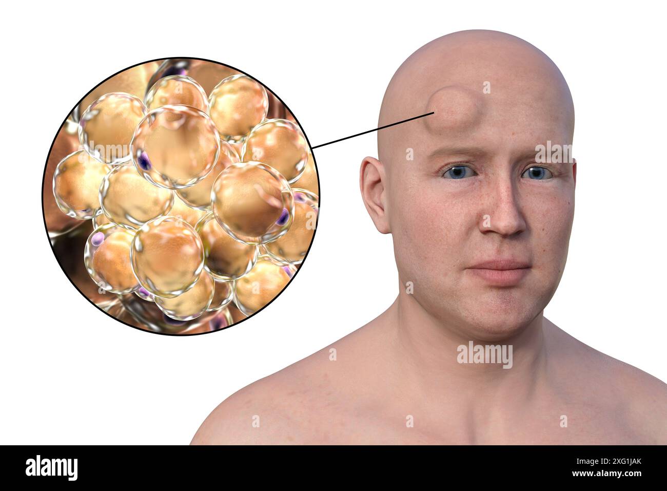 Illustration of a man with a lipoma on his forehead, and close-up view ...
