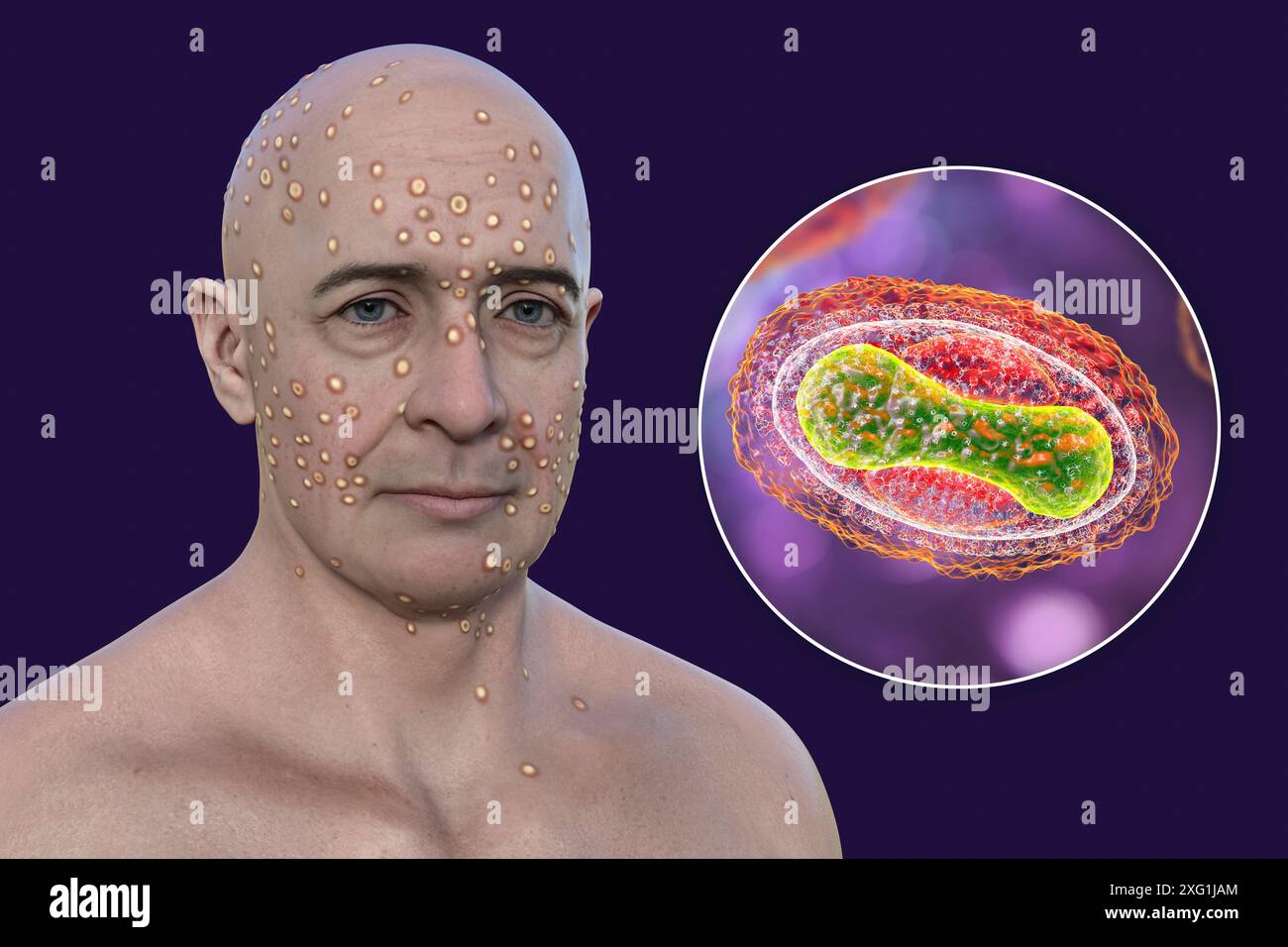 Man with rash from pox virus infection hi-res stock photography and ...