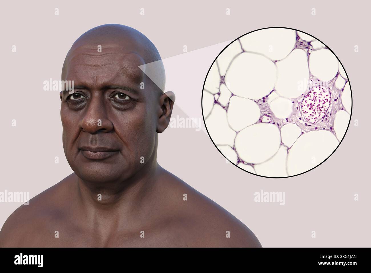 Illustration of a man with a lipoma on his forehead, and close-up view ...