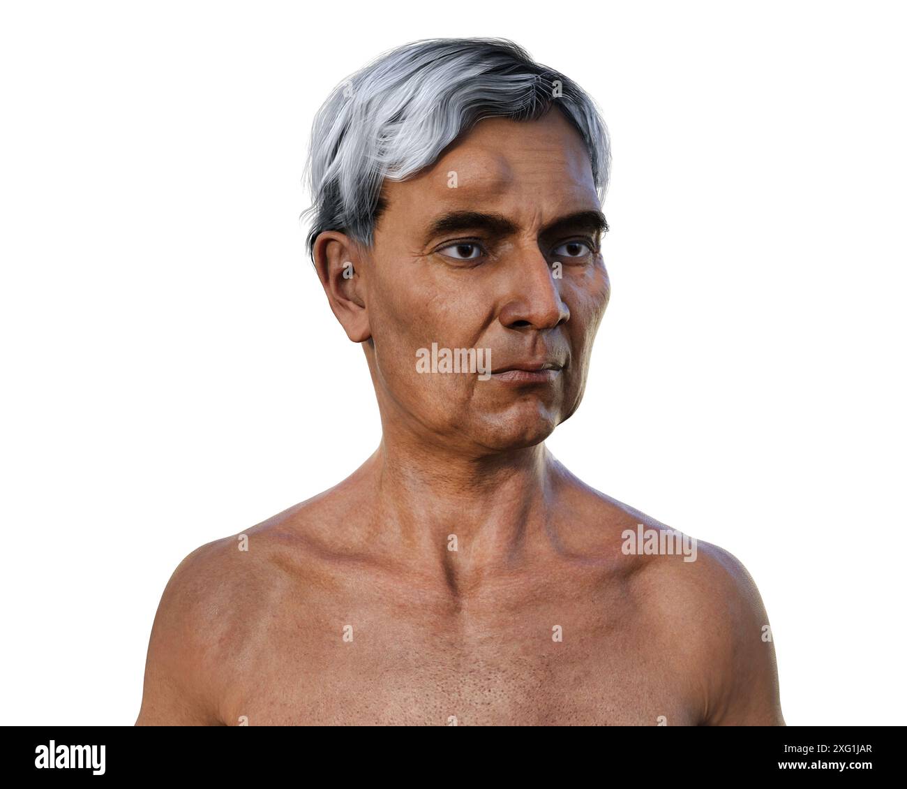 Illustration of a man with a lipoma on his forehead. Lipomas are benign ...