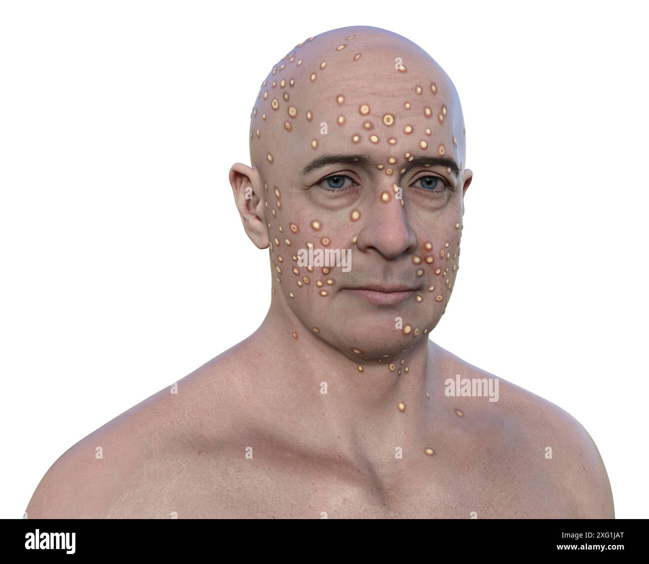 Illustration of a man with a rash caused by infection with a pox virus ...