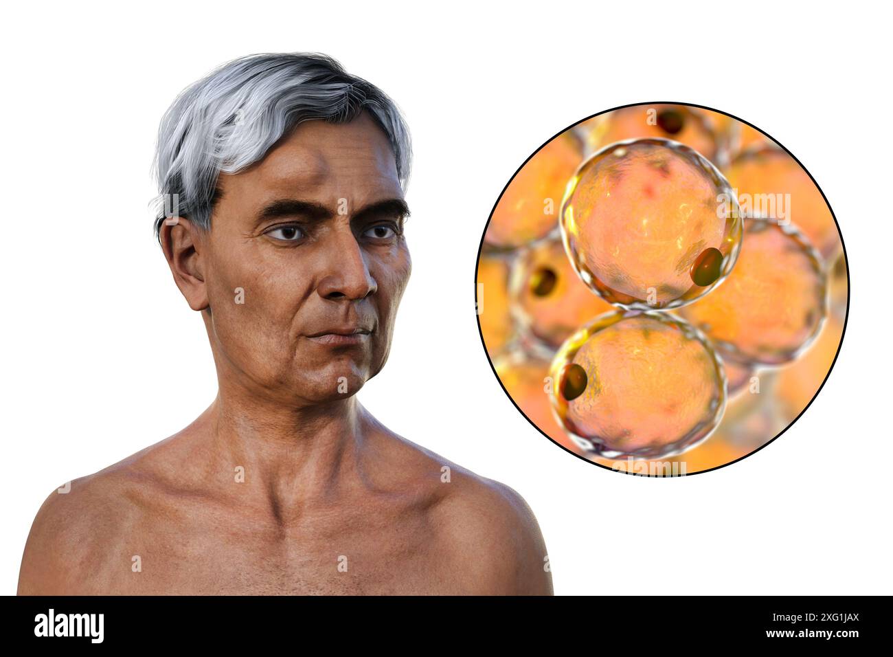 Illustration of a man with a lipoma on his forehead, and close-up view ...