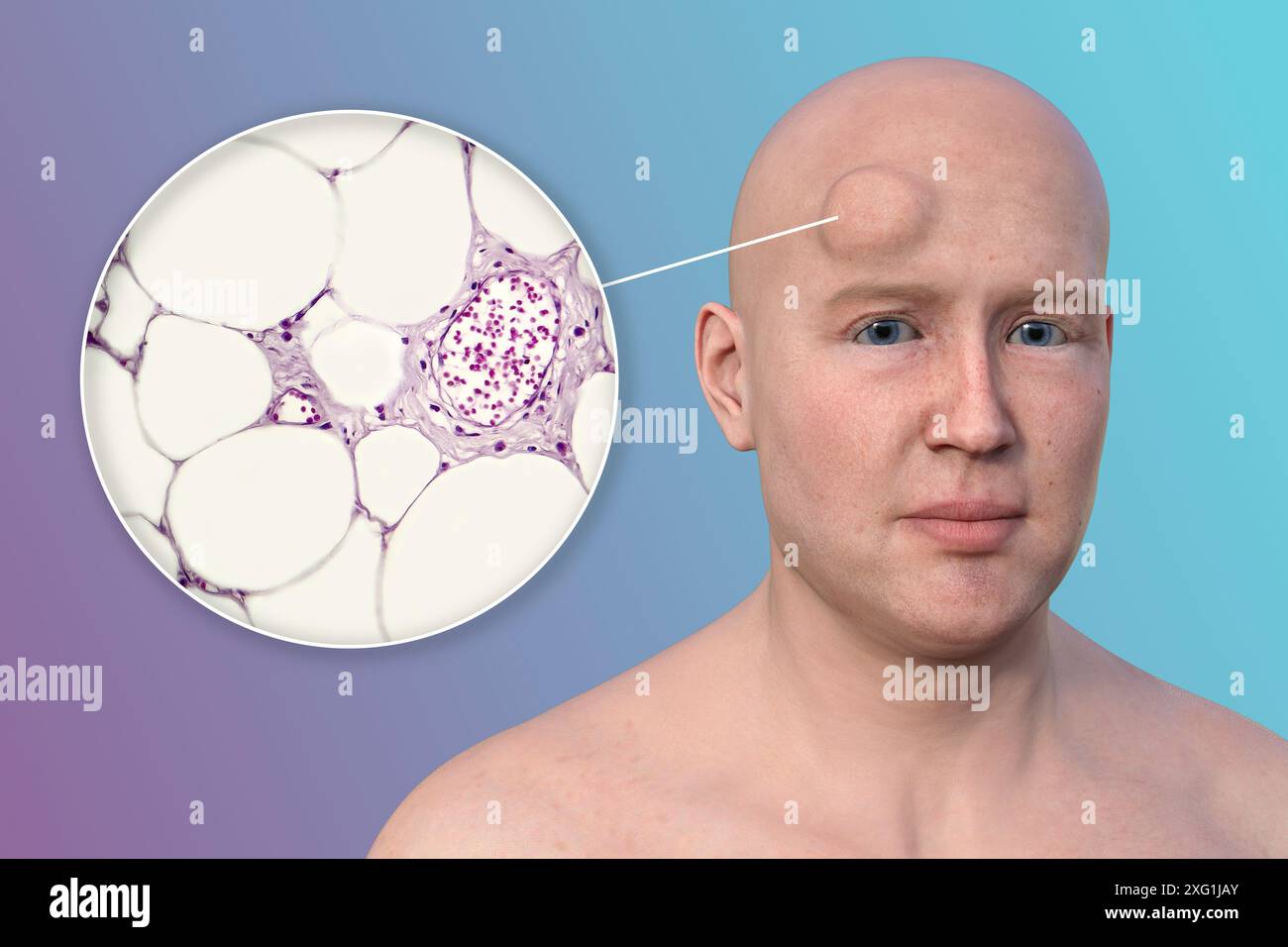 Illustration of a man with a lipoma on his forehead, and close-up view ...