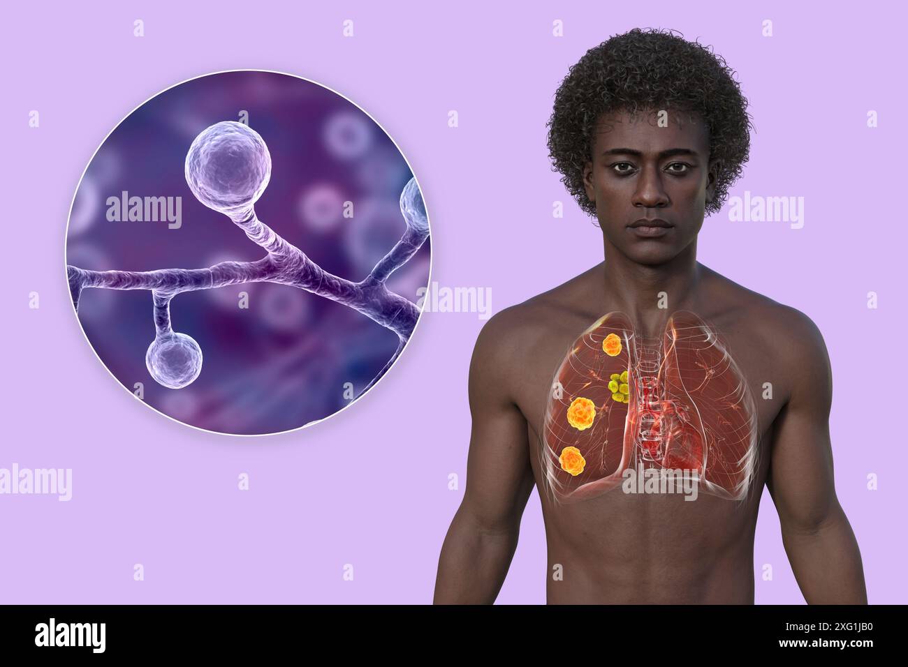 Illustration of pulmonary blastomycosis, and a close-up of the ...