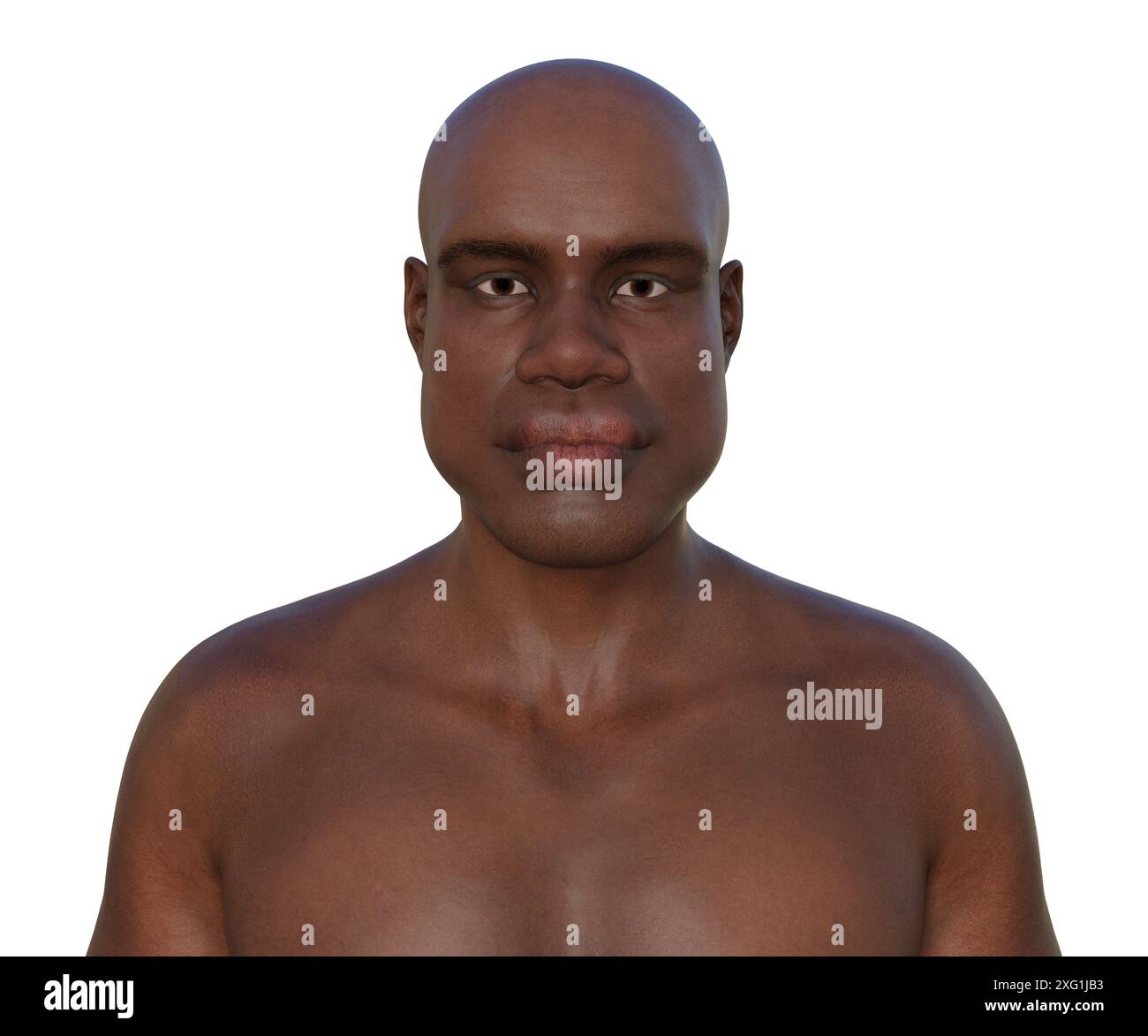 Acromegaly hi-res stock photography and images - Alamy