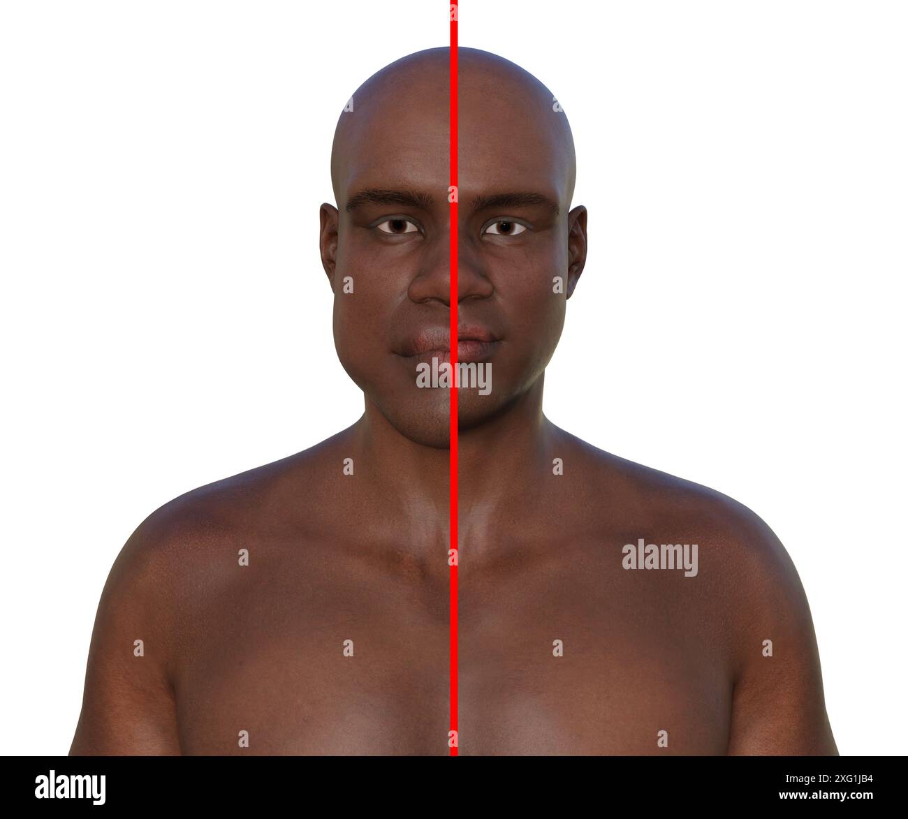Illustration comparing a man with acromegaly (left) and the same ...