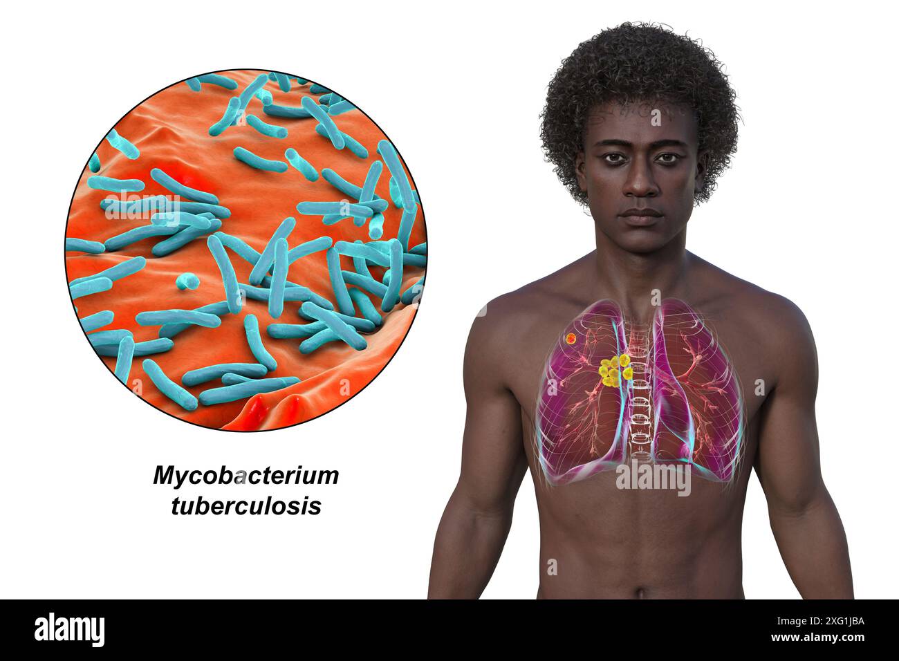 Illustration of a man's thoracic (chest) cavity revealing a Ghon ...