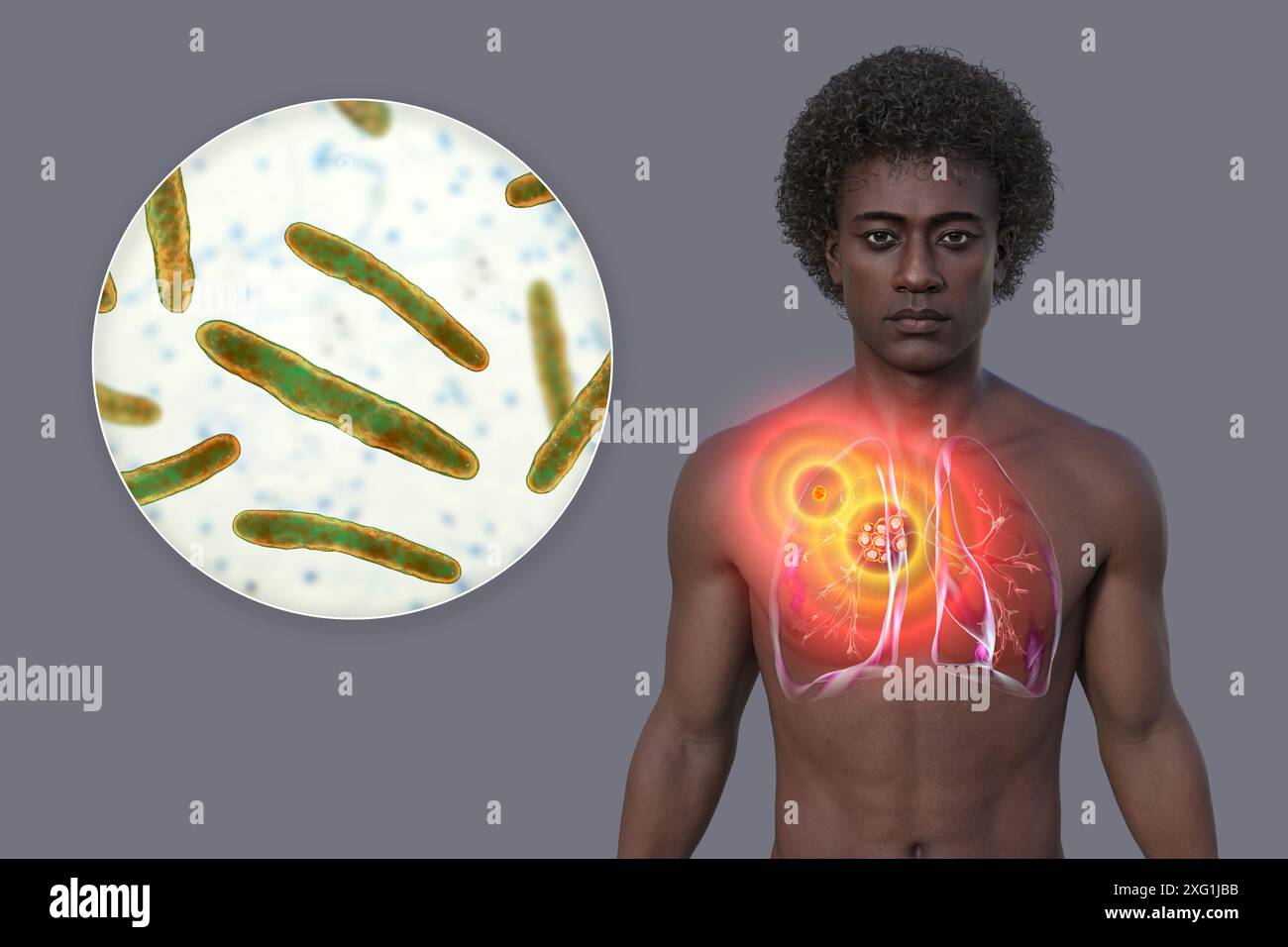 Illustration of a man's thoracic (chest) cavity revealing a Ranke ...