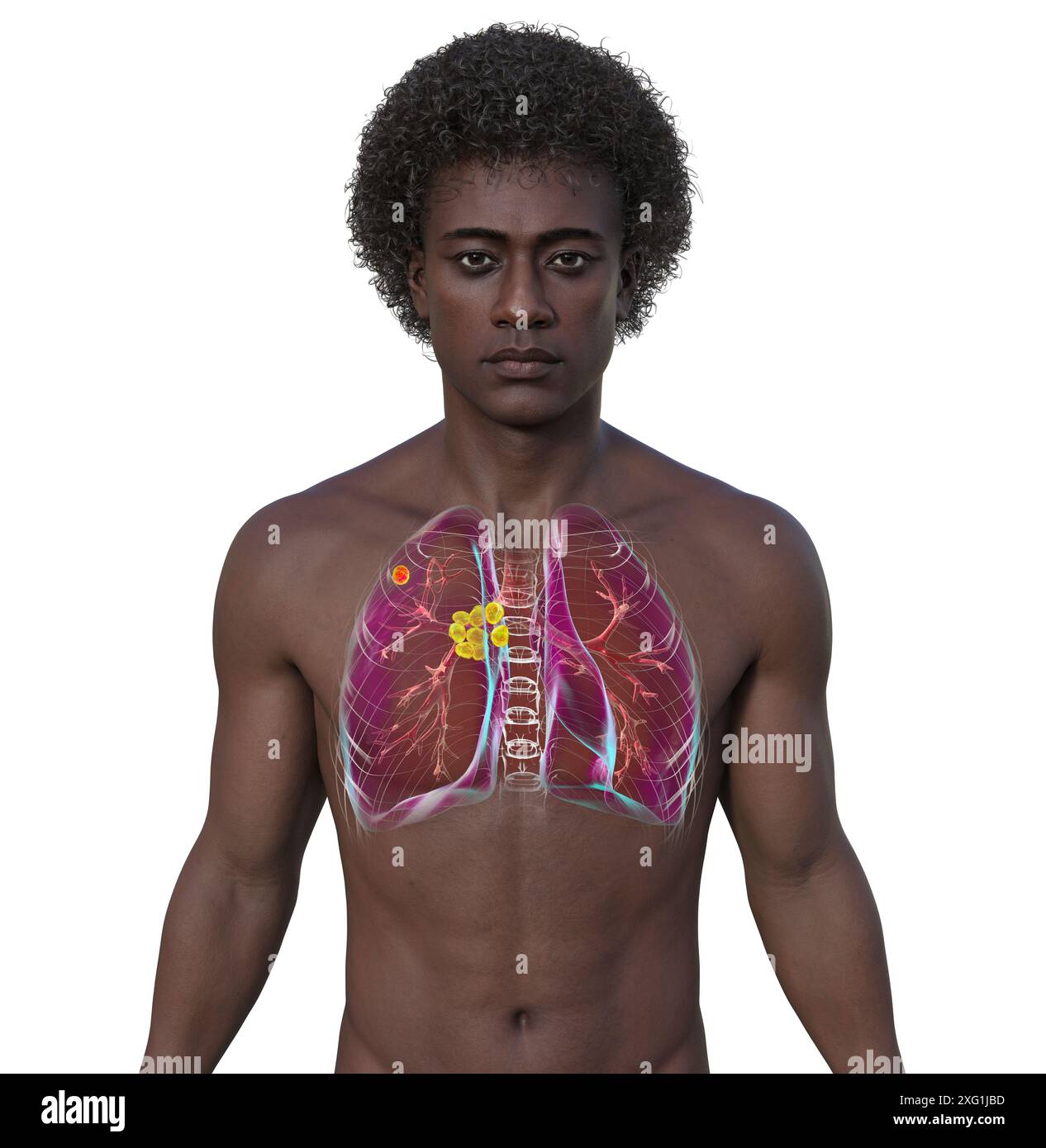 Non granulomatous hi-res stock photography and images - Alamy