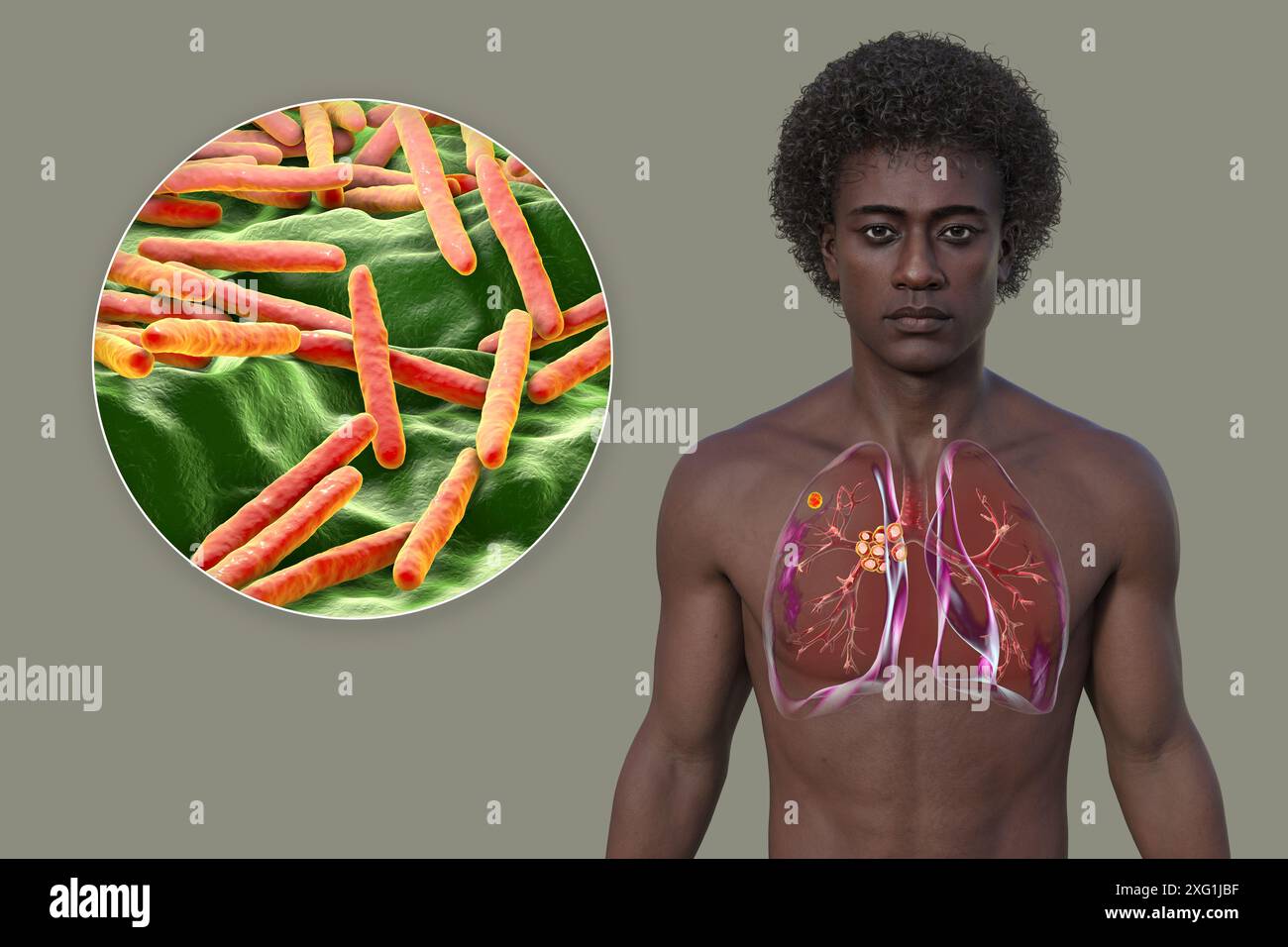 Illustration of a man's thoracic (chest) cavity revealing a Ranke ...