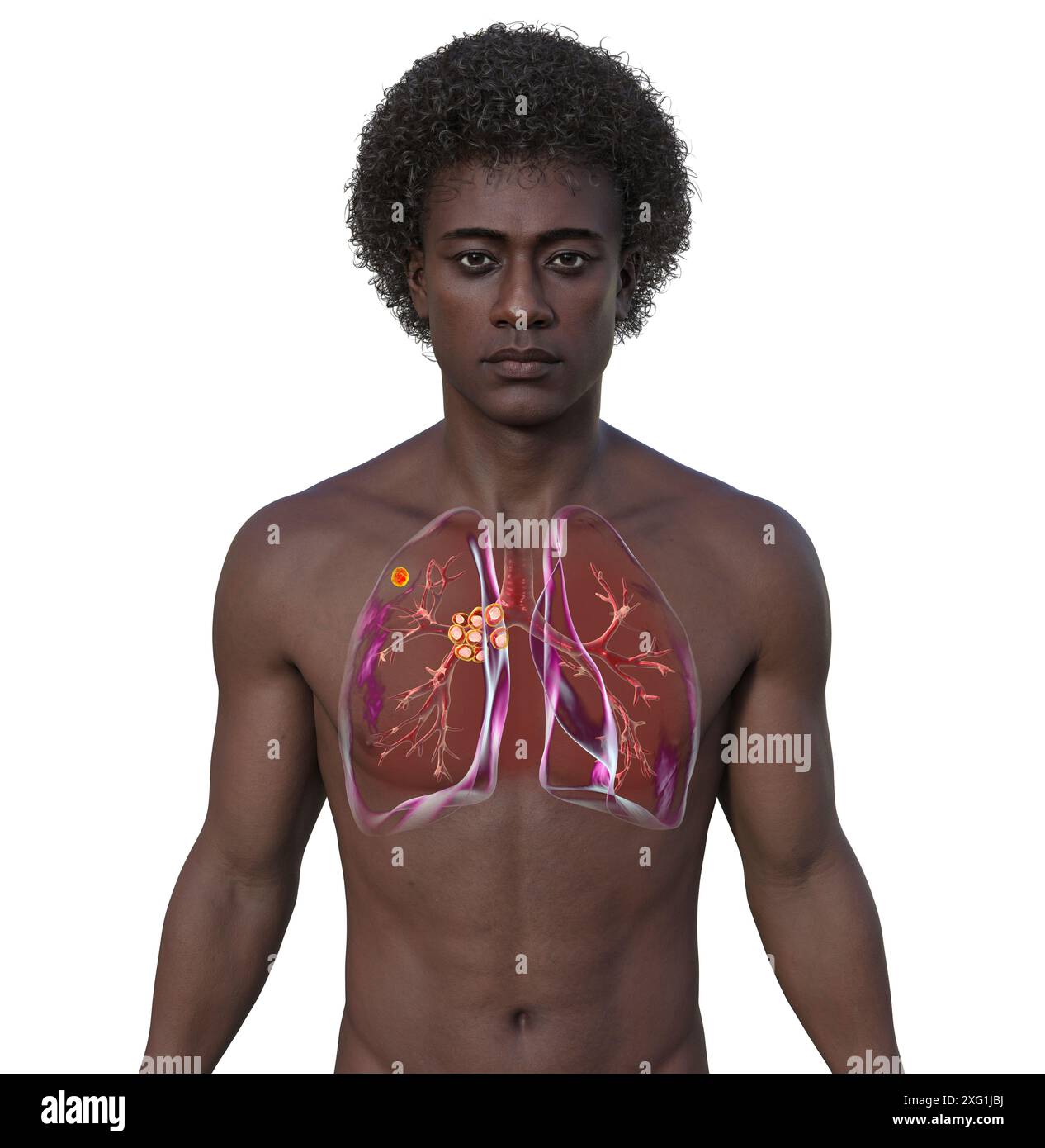 Illustration of a man's thoracic (chest) cavity revealing a Ranke ...