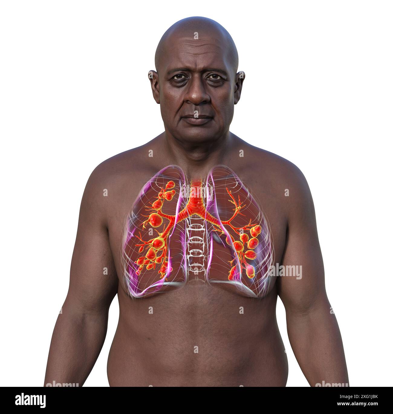 Illistration of a man with cystic fibrosis, a genetic disorder causing ...
