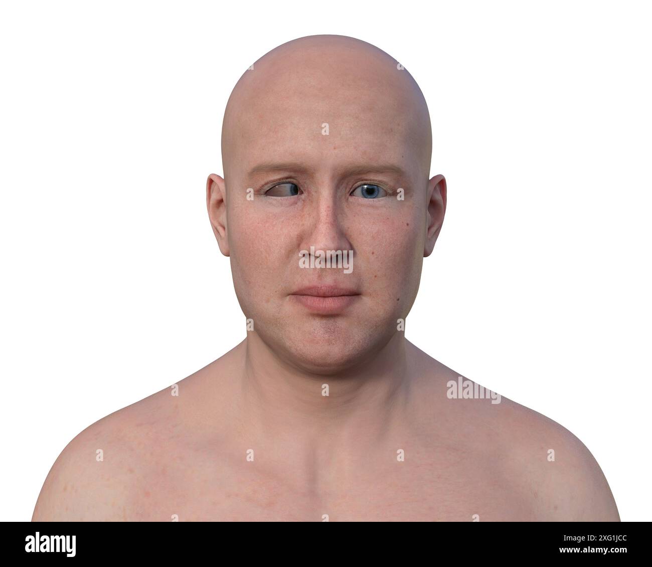 Illustration of a man with esotropia showing inward eye misalignment ...
