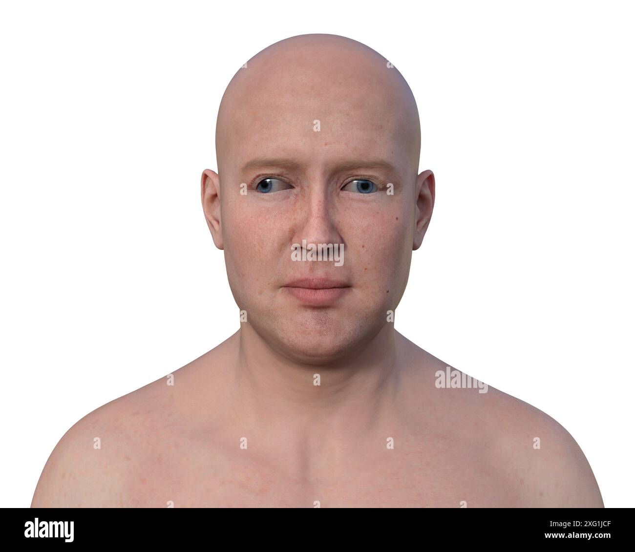 Illustration of a man with exotropia showing inward eye misalignment ...