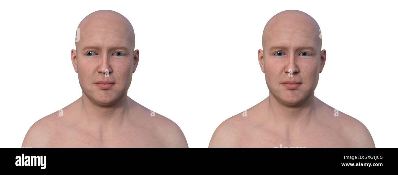 Illustration of a man with exotropia showing outward eye misalignment ...