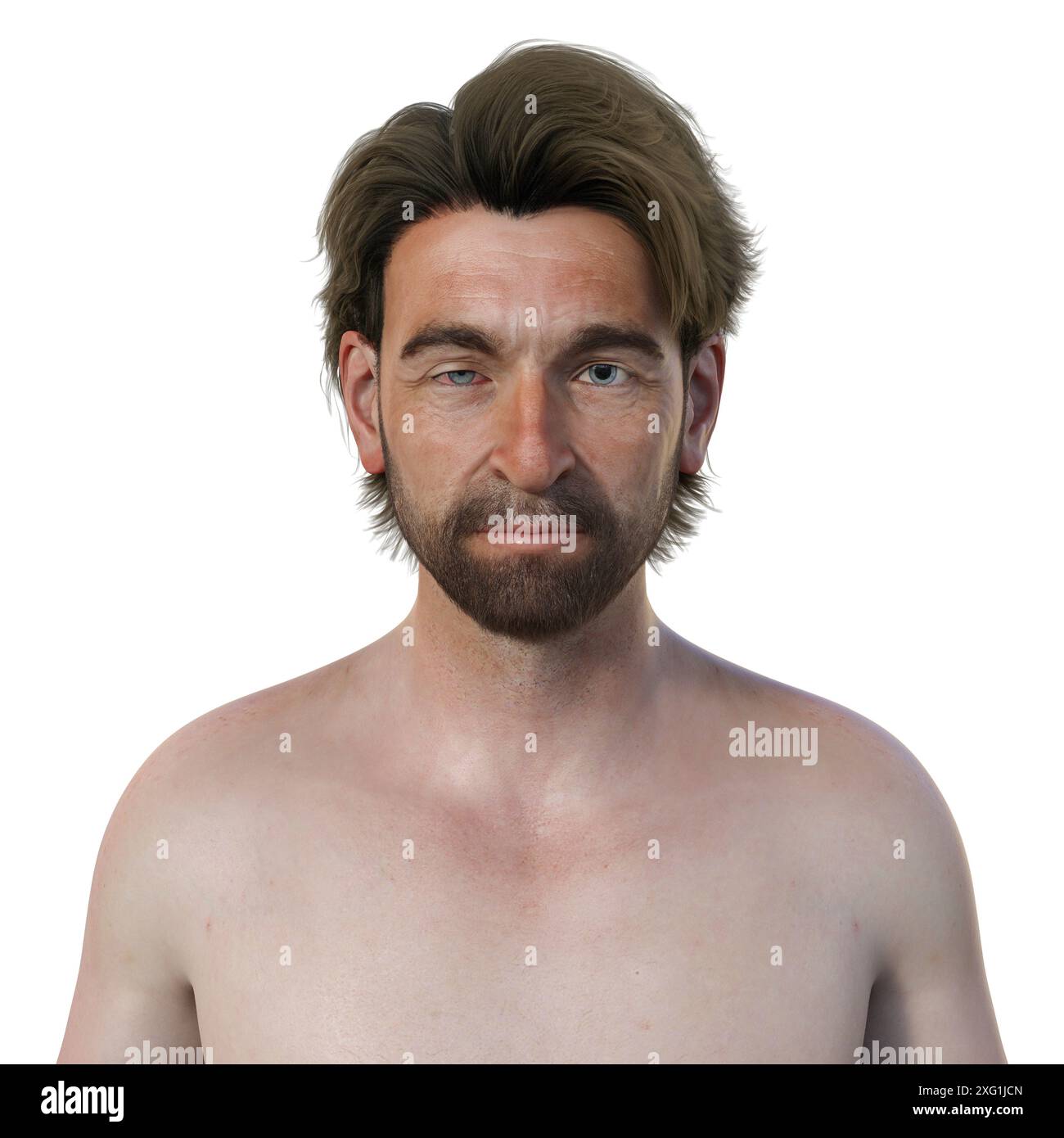 Illustration of a man with Horner syndrome. This is a rare condition ...