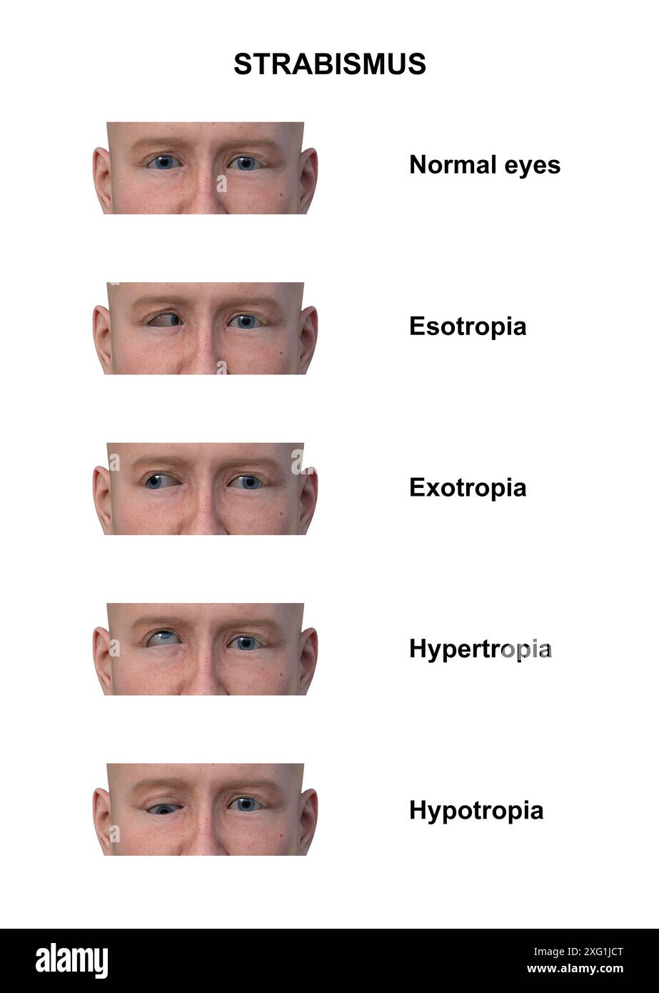 Labelled illustration of a man with various strabismus types: esotropia ...