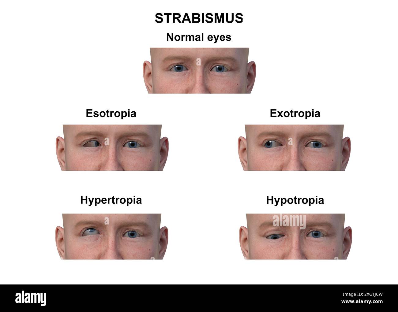Labelled illustration of a man with various strabismus types: esotropia ...