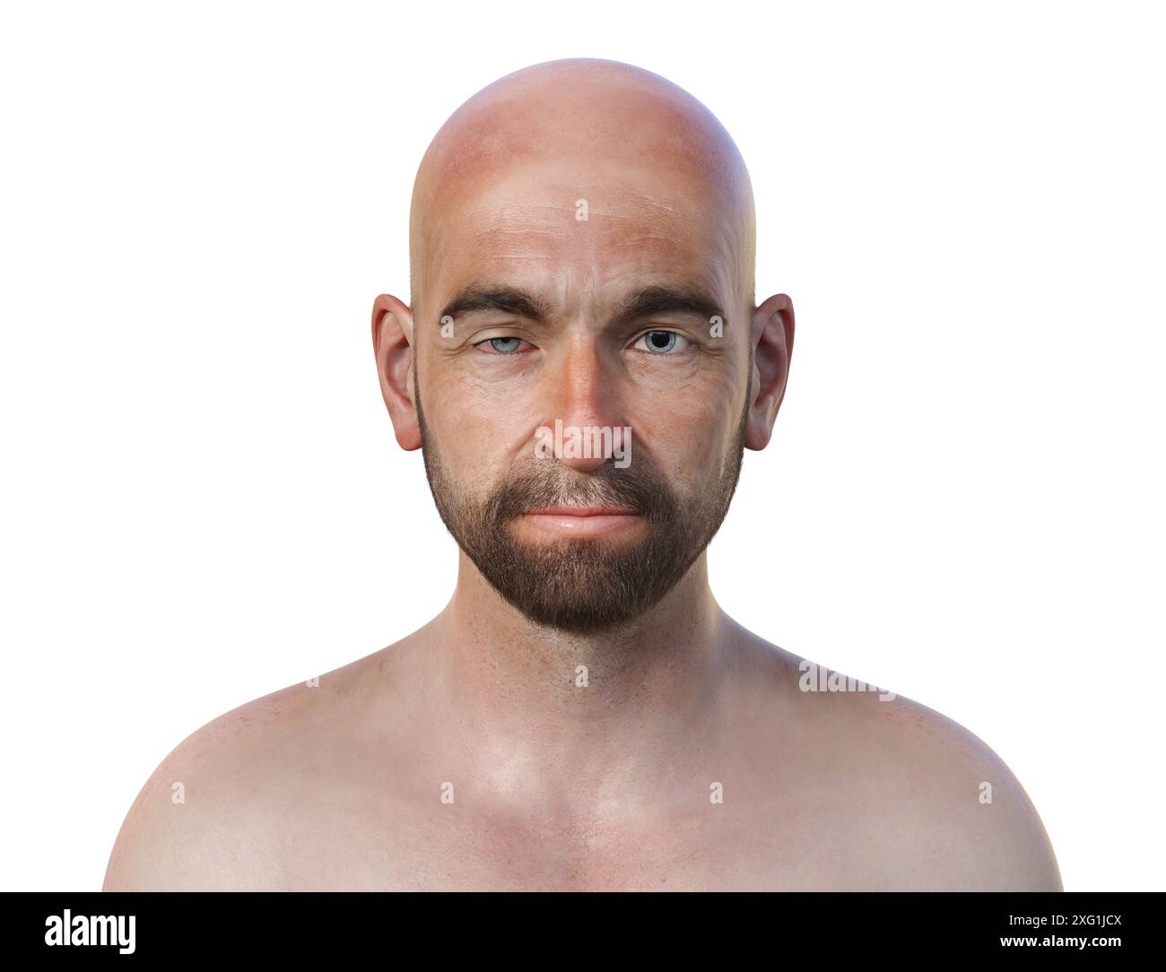 Illustration of a man with Horner syndrome. This is a rare condition ...