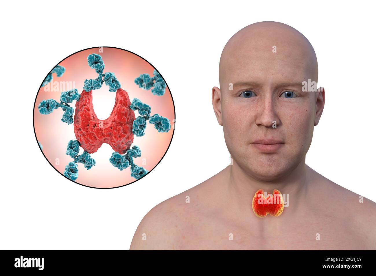 Illustration of a man with Hashimoto's disease. This is an autoimmune ...