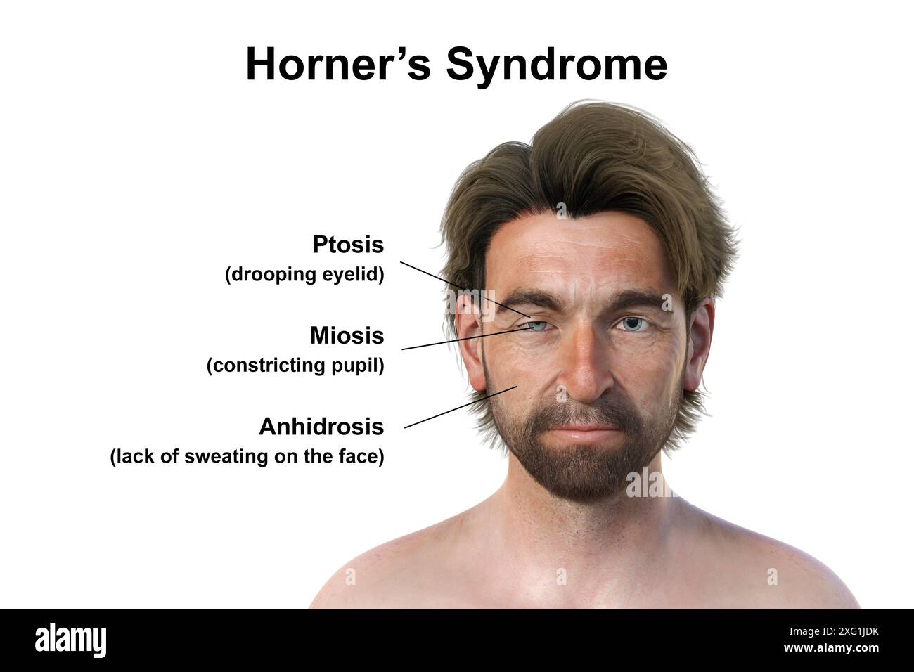 Labelled illustration of a man with Horner syndrome. This is a rare ...