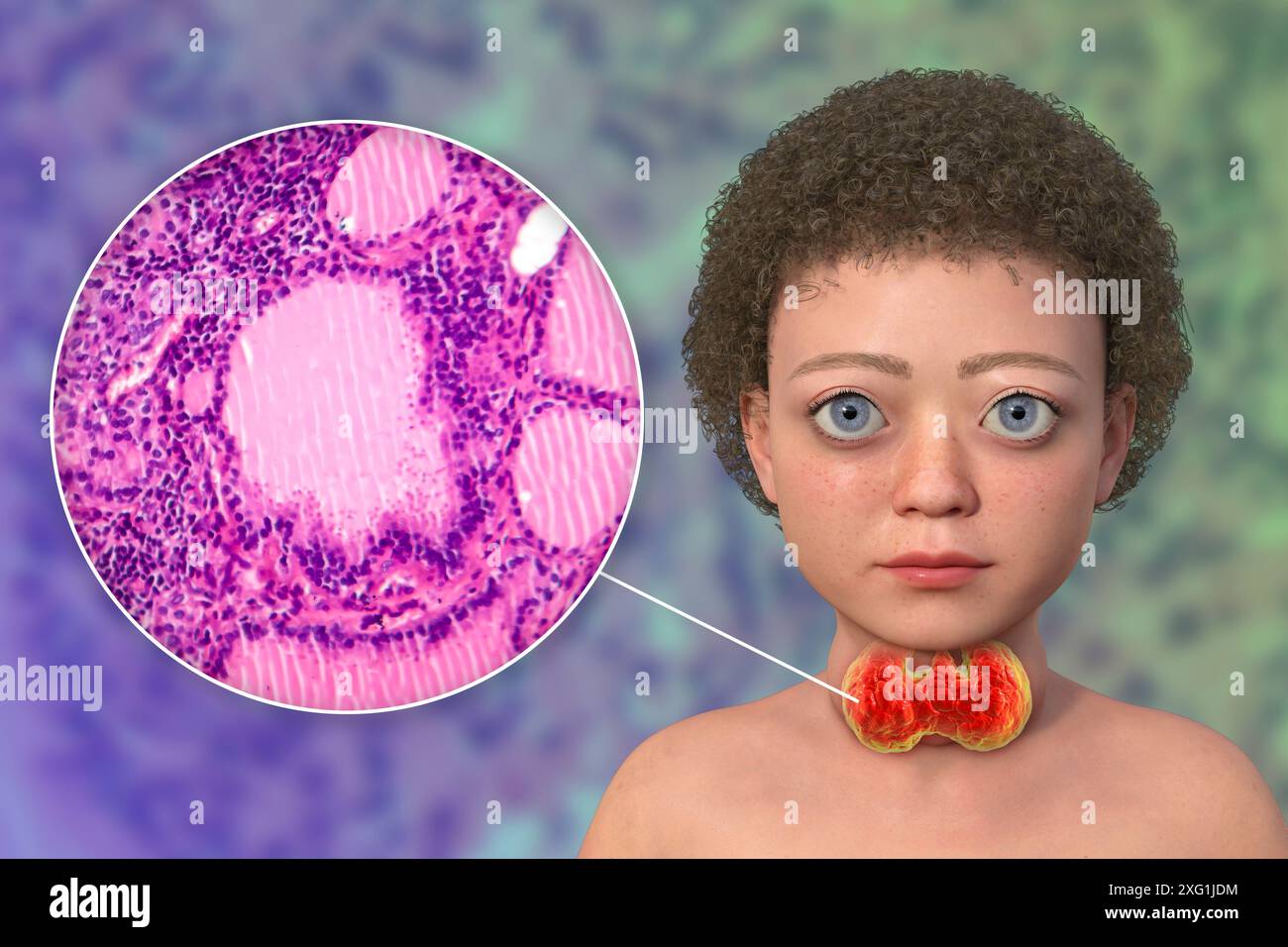 Illustration of a child with Graves' disease and a close-up of the ...