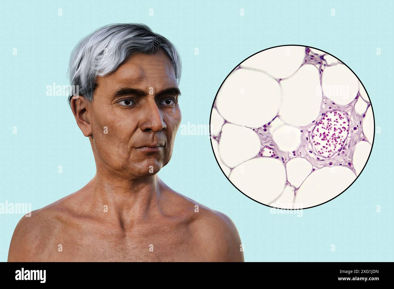 Illustration of a man with a lipoma on his forehead, and close-up view ...