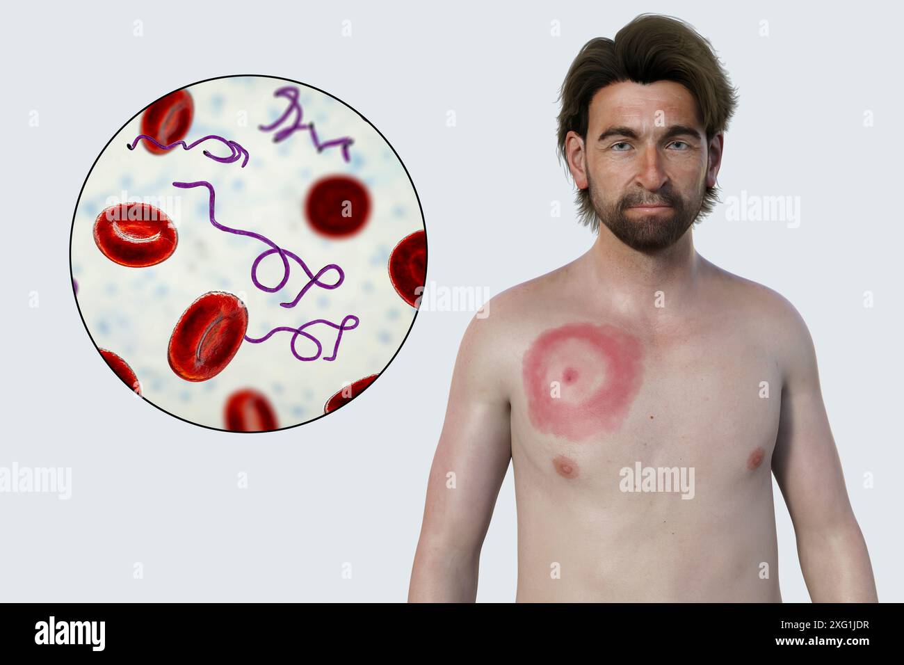 Illustration showing erythema migrans, a characteristic rash seen in patients with Lyme disease ...