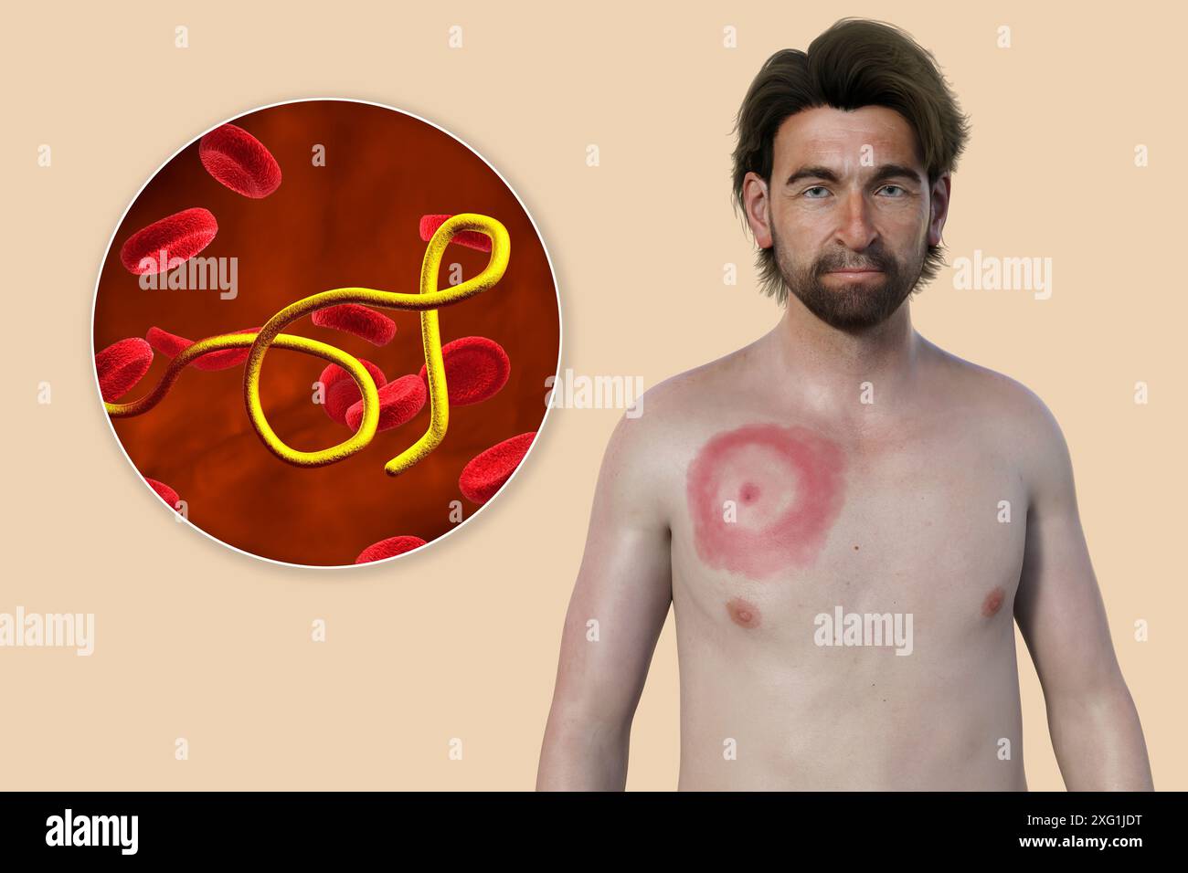 Illustration showing erythema migrans, a characteristic rash seen in ...