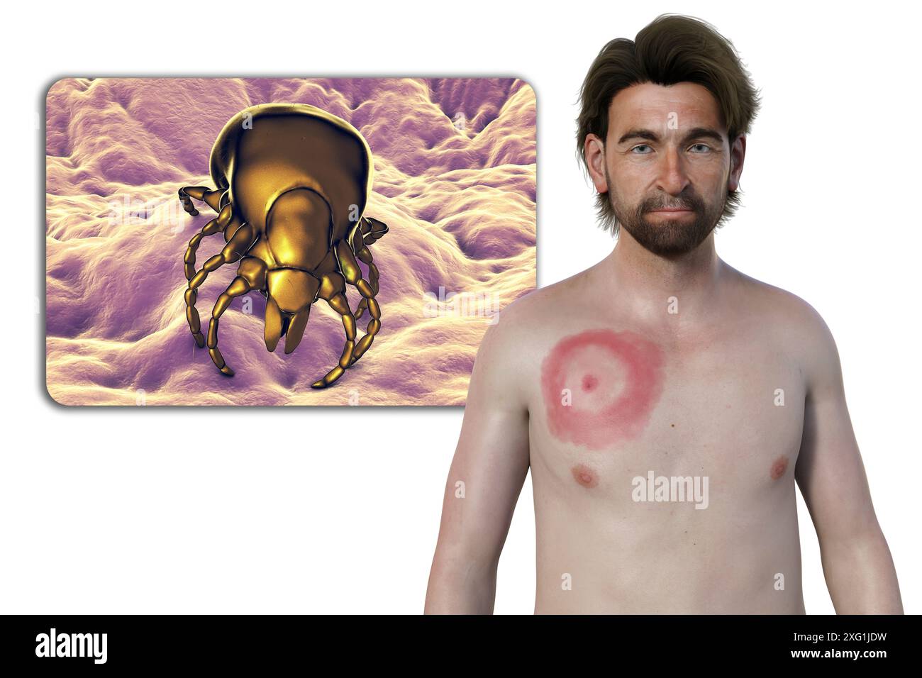 Illustration showing erythema migrans, a characteristic rash seen in ...