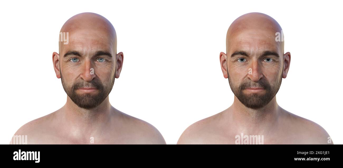 Illustration of a man with constricted eye pupils, known as miosis ...