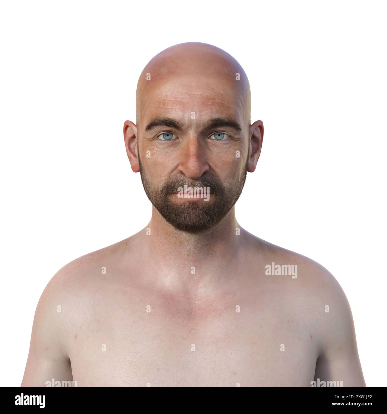 Illustration of a man with miosis (constricted eye pupils Stock Photo ...