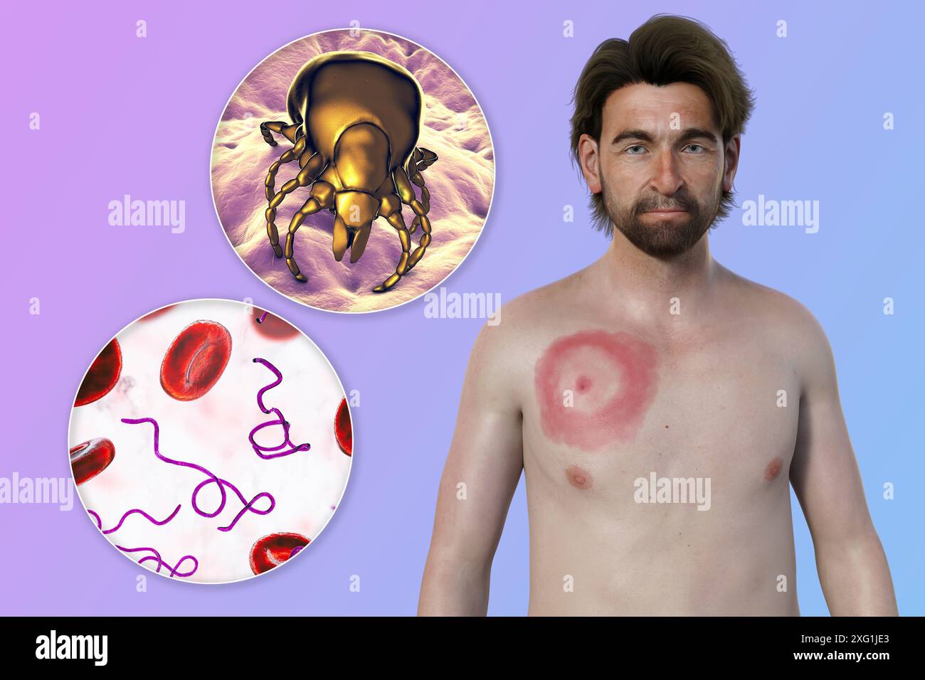 Illustration showing erythema migrans, a characteristic rash seen in patients with Lyme disease ...