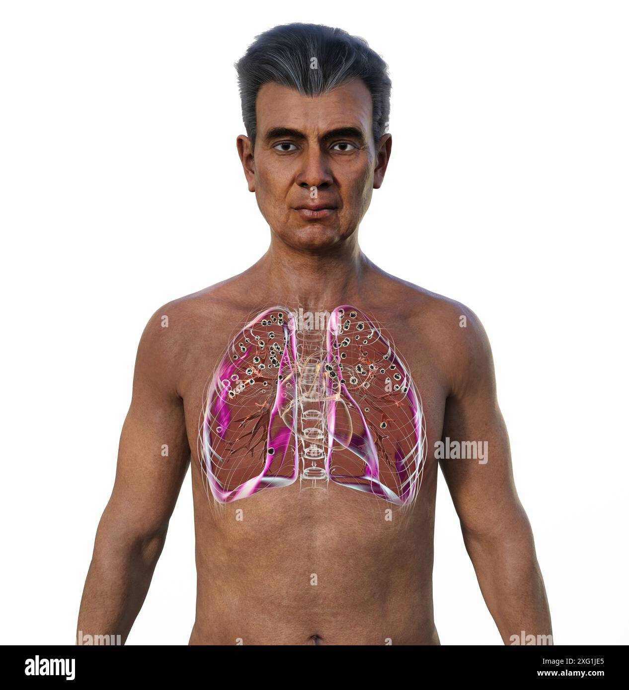 Illustration of a man with lungs affected by silicosis, showing dark ...