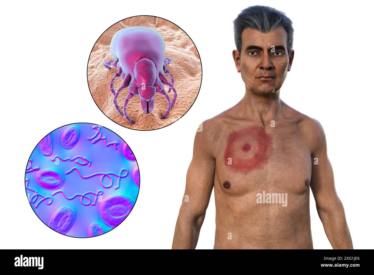 Illustration showing erythema migrans, a characteristic rash seen in ...