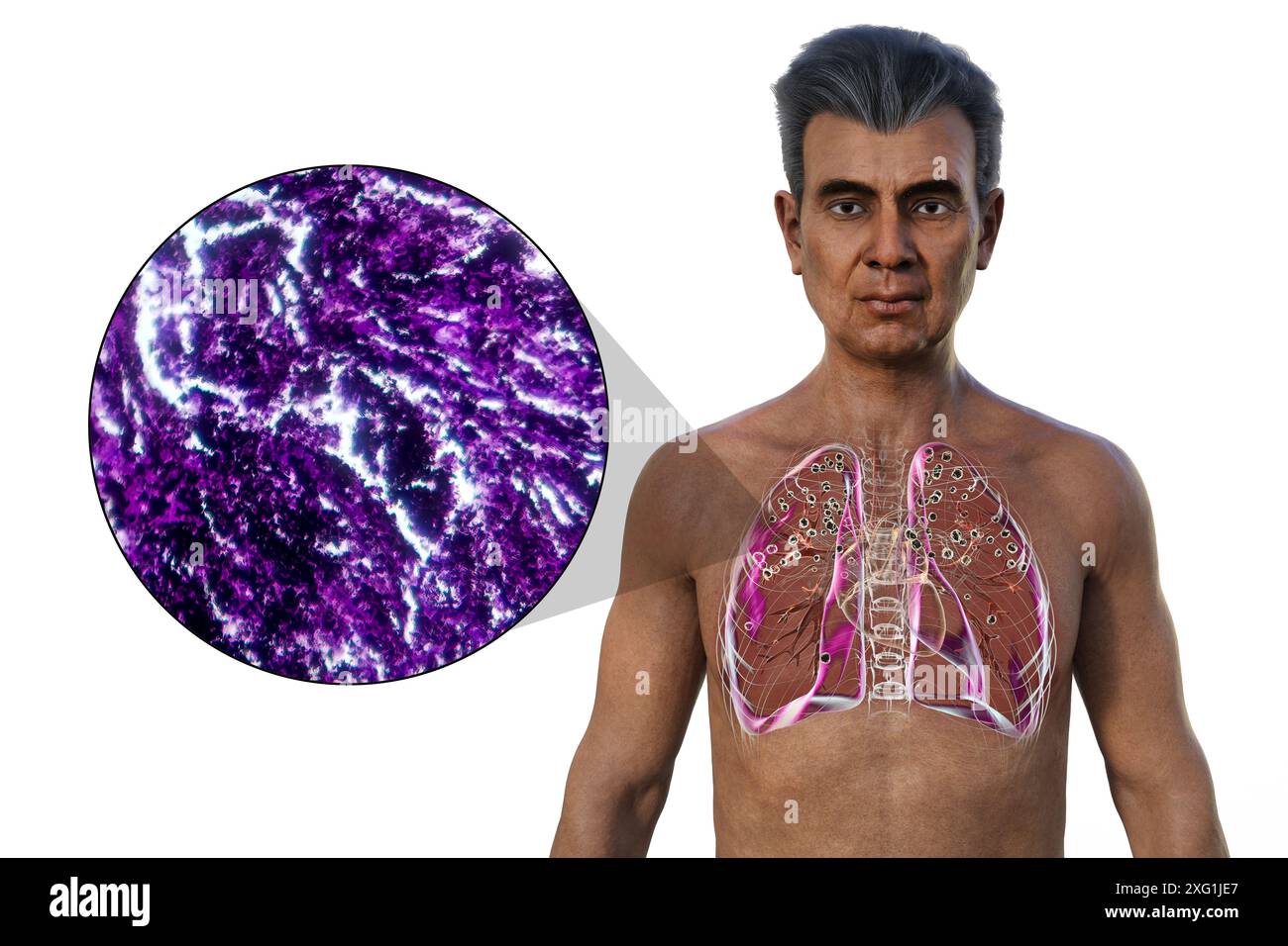 Illustration of a man with lungs affected by silicosis, showing dark silicotic nodules, and a ...