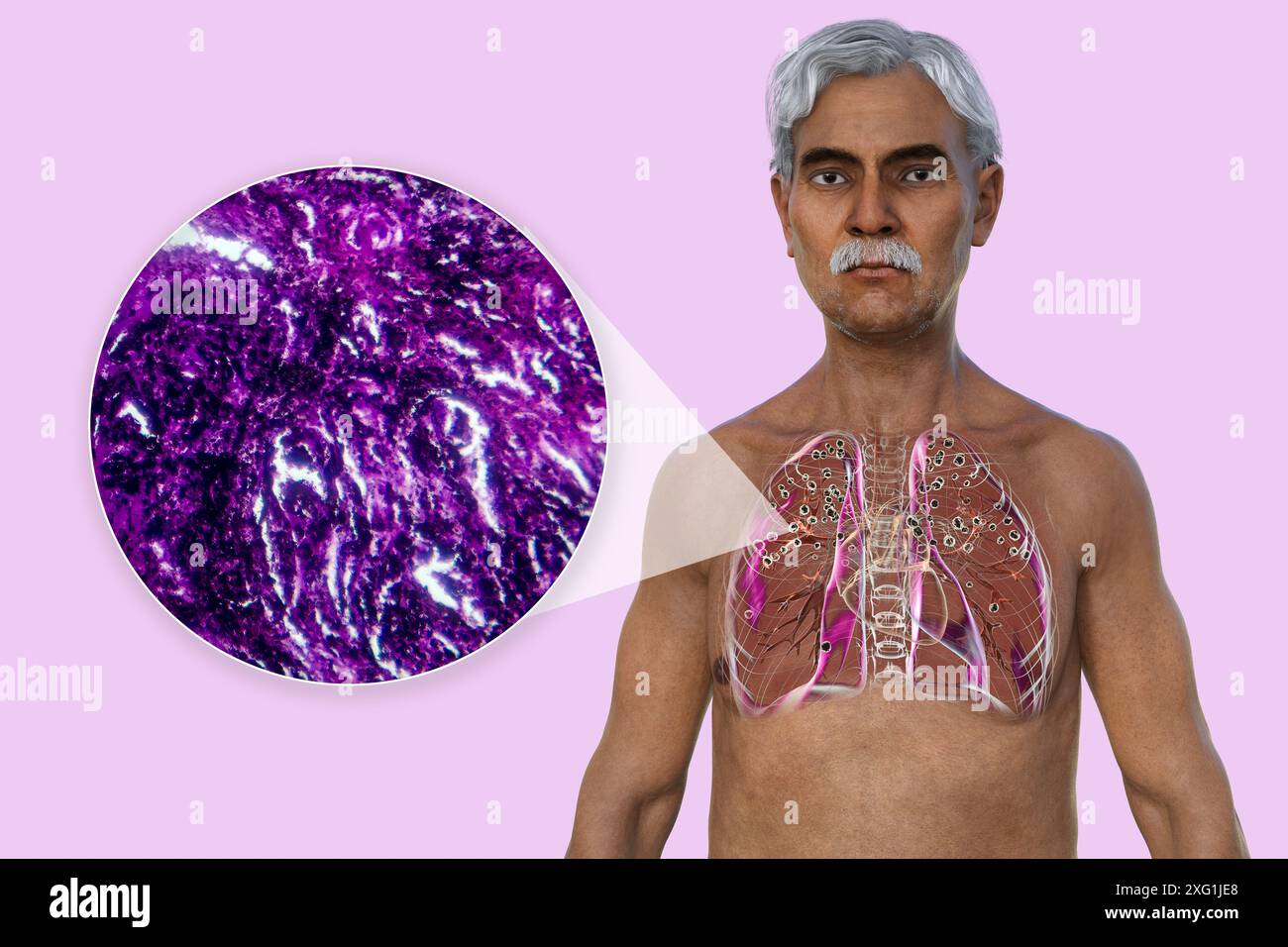 Illustration of a man with lungs affected by silicosis, showing dark ...