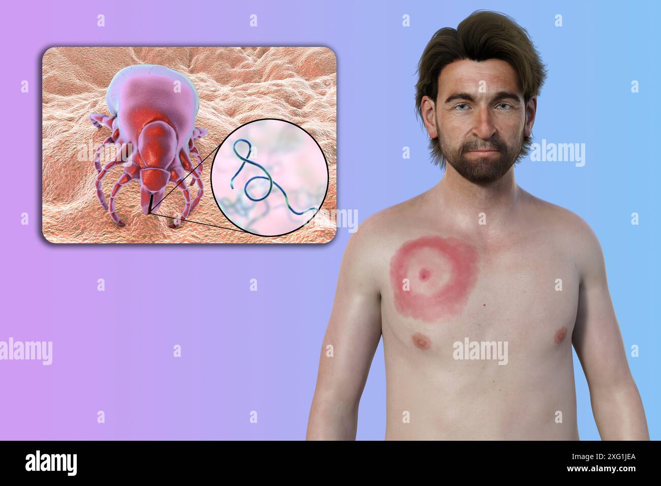 Illustration showing erythema migrans, a characteristic rash seen in ...