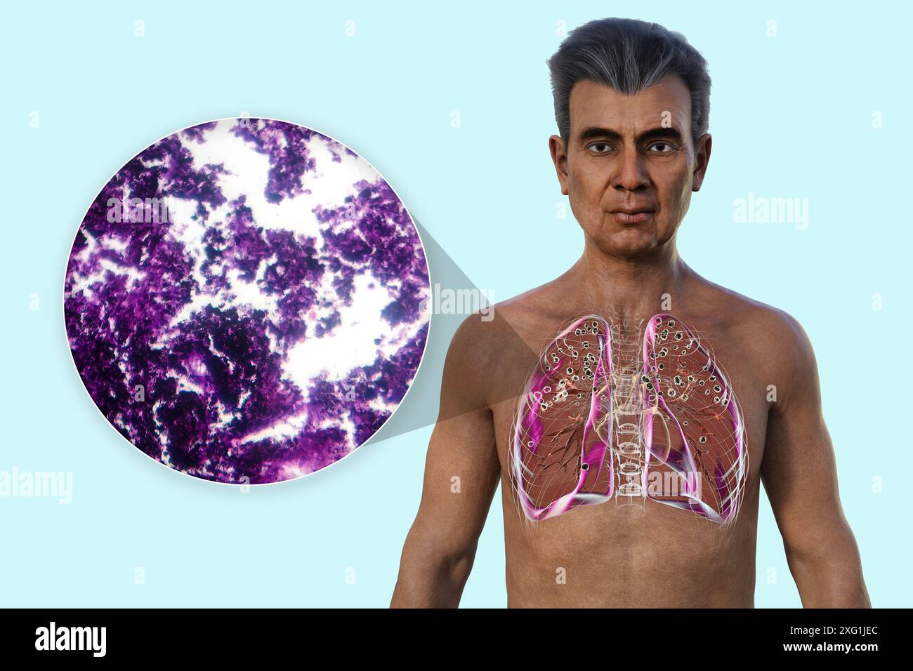 Illustration of a man with lungs affected by silicosis, showing dark ...