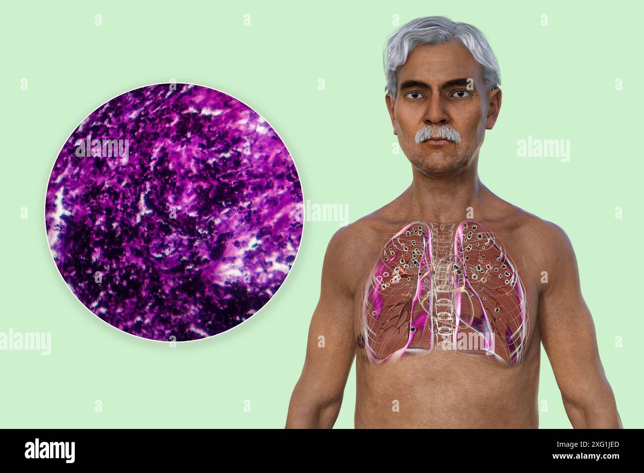 Illustration of a man with lungs affected by silicosis, showing dark ...