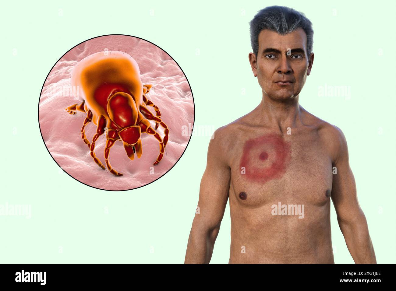 Illustration showing erythema migrans, a characteristic rash seen in ...