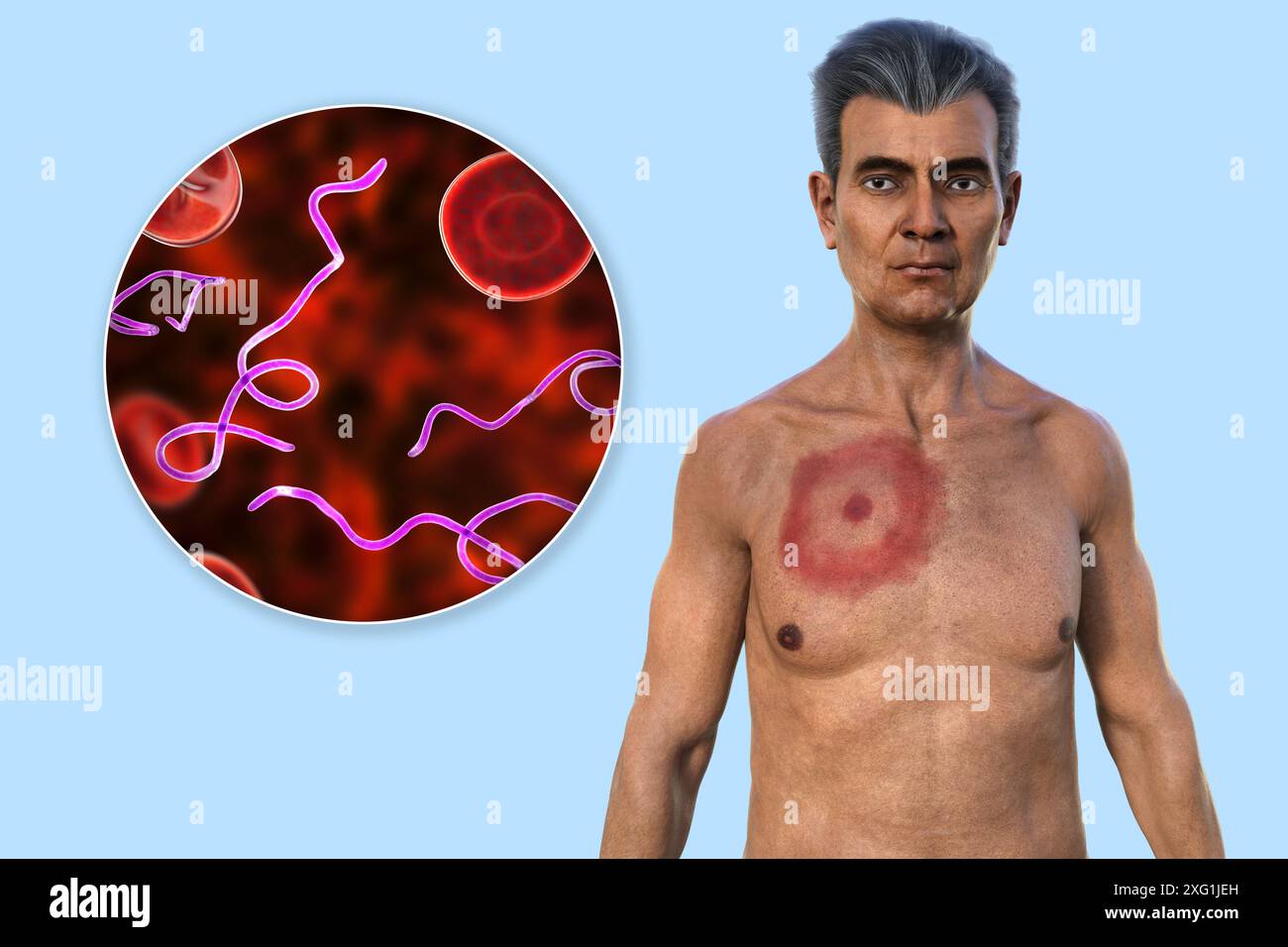 Man with erythema migrans from lyme disease hi-res stock photography ...